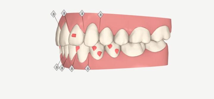 ¿Qué son los ataches en Invisalign? - Clínica Dental Zahne